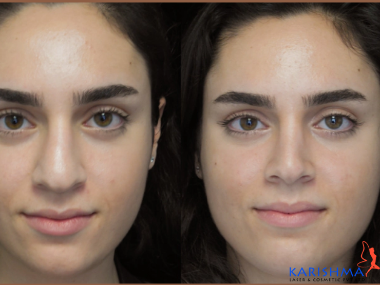 Types Of Noses - How Many Types Of Noses Are There?